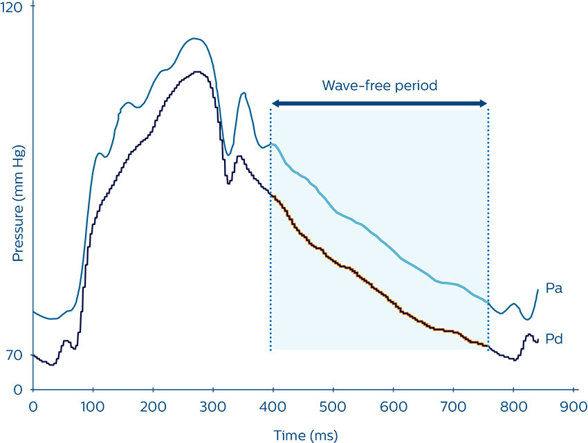 Coronary Physiology Modalities: iFR and FFR | Philips