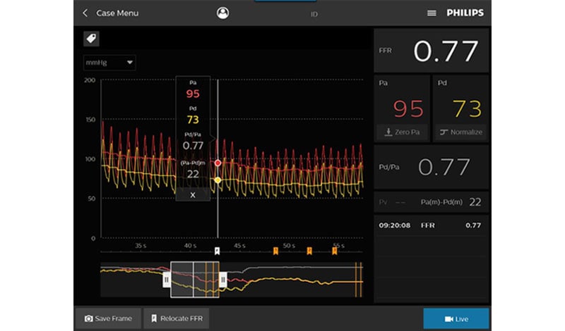 Coronary Physiology Modalities: iFR and FFR | Philips