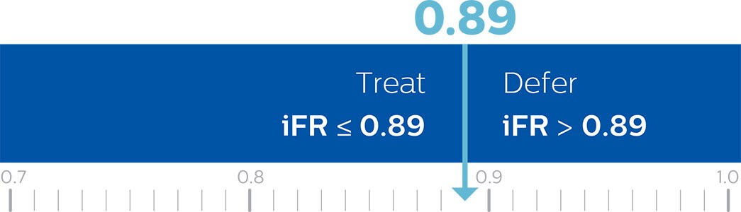 Coronary Physiology Modalities: iFR and FFR | Philips