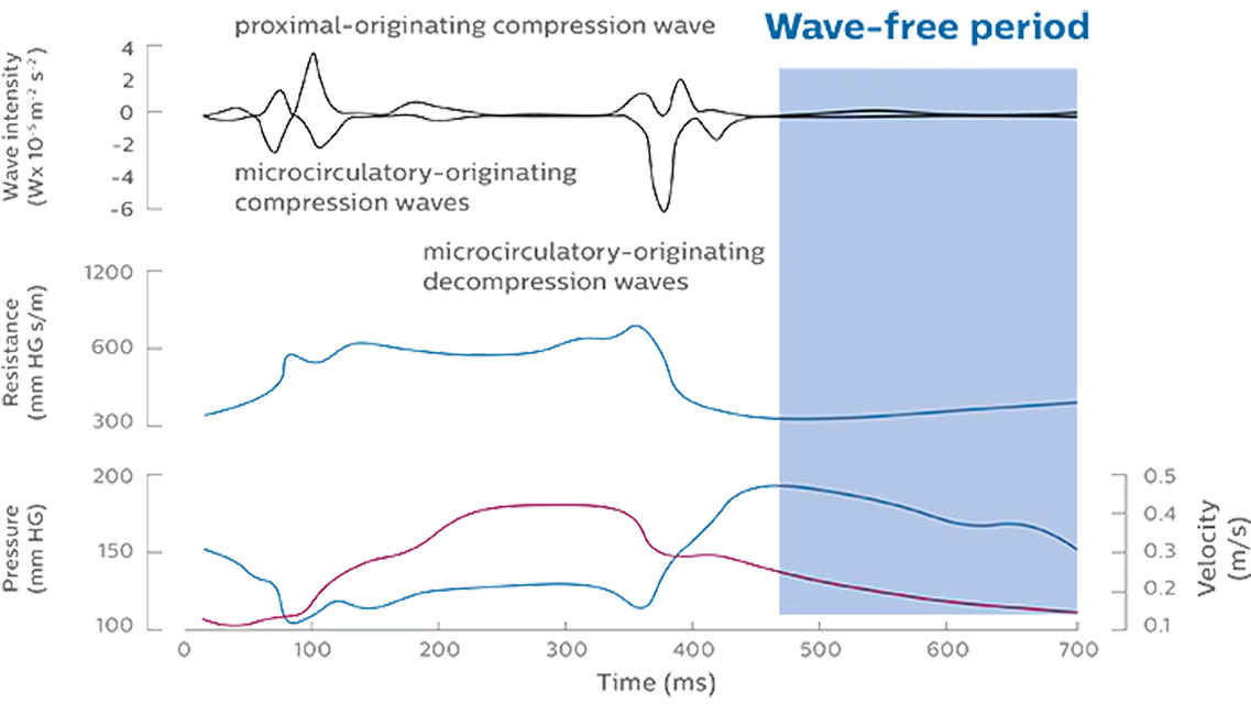 Coronary Physiology Modalities: iFR and FFR | Philips