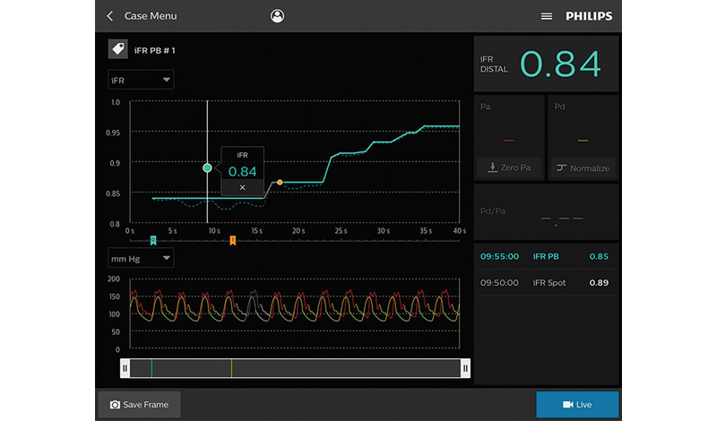 Coronary Physiology Modalities: iFR and FFR | Philips