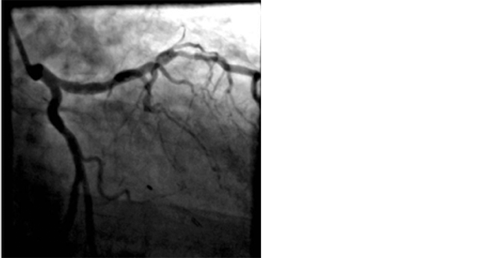 Intravascular Ultrasound (IVUS) | Philips Healthcare