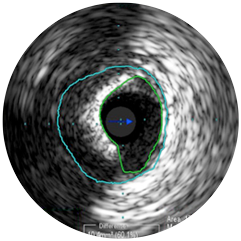 Intravascular Ultrasound (IVUS) | Philips Healthcare