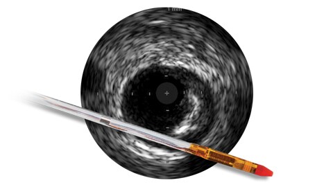 IVUS - Intravascular Ultrasound | Philips Healthcare