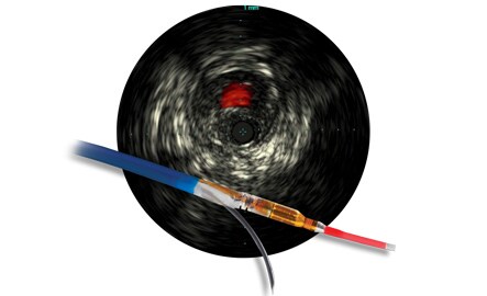IVUS - Intravascular Ultrasound | Philips Healthcare