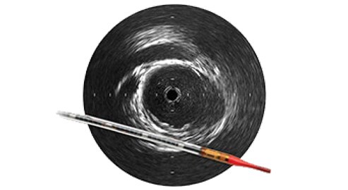 IVUS - Intravascular Ultrasound | Philips