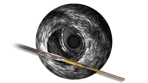 IVUS - Intravascular Ultrasound | Philips Healthcare