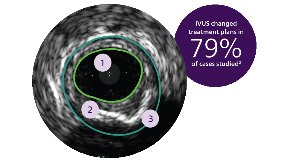 Peripheral IVUS - Intravascular Ultrasound | Philips