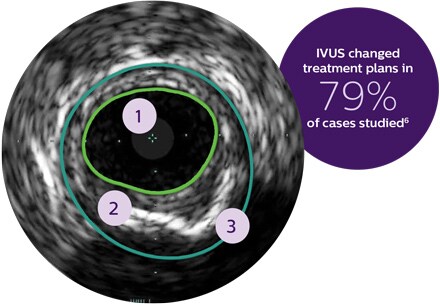 Peripheral IVUS - Intravascular Ultrasound | Philips Healthcare