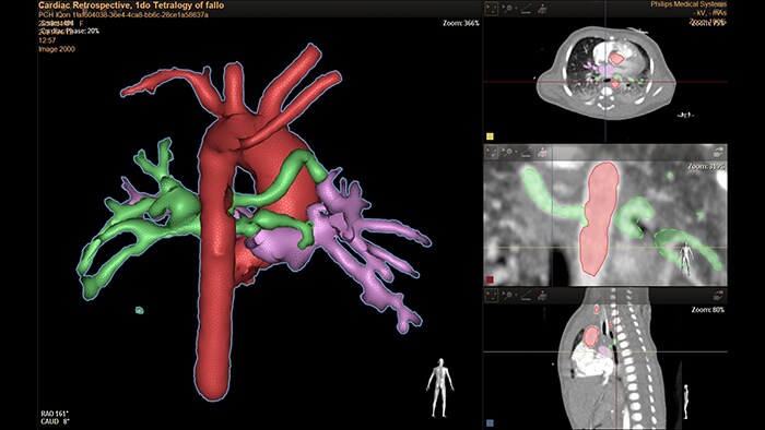 Congenital Heart Disease Interventions | Philips Healthcare