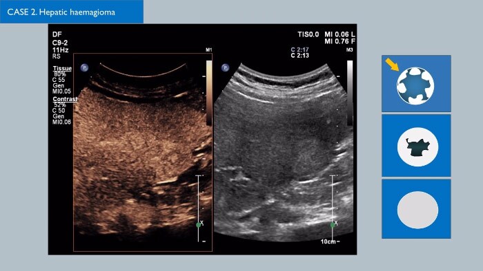 CEUS Contrast-Enhanced Ultrasound | Philips Healthcare