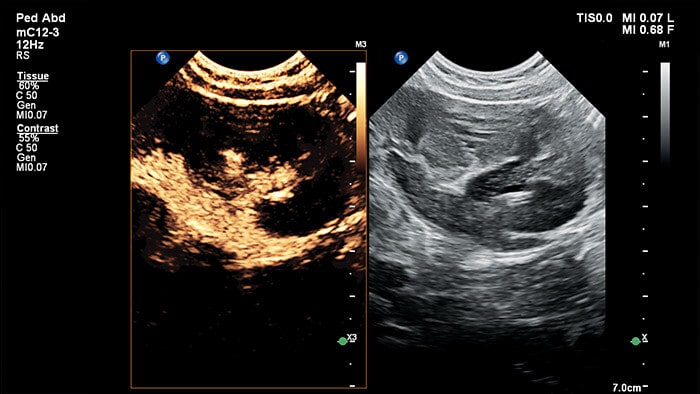 Pediatric Ultrasound Solution | Philips Healthcare